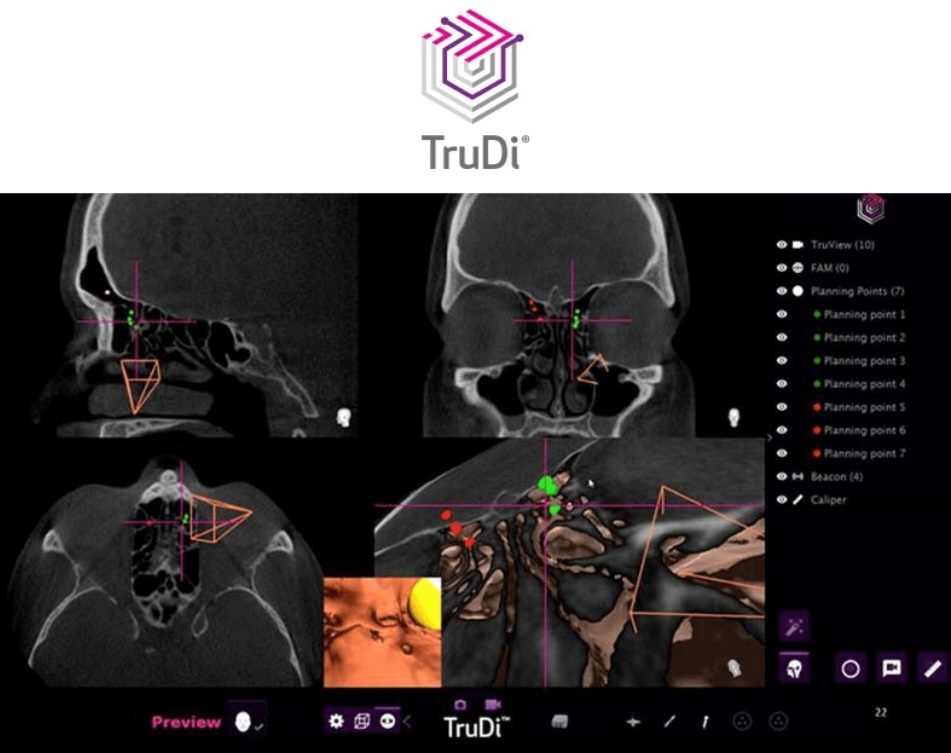 TruDi Navigation system – Dr. Ameen, Pakar Ear, Nose and Throat (Adult ...