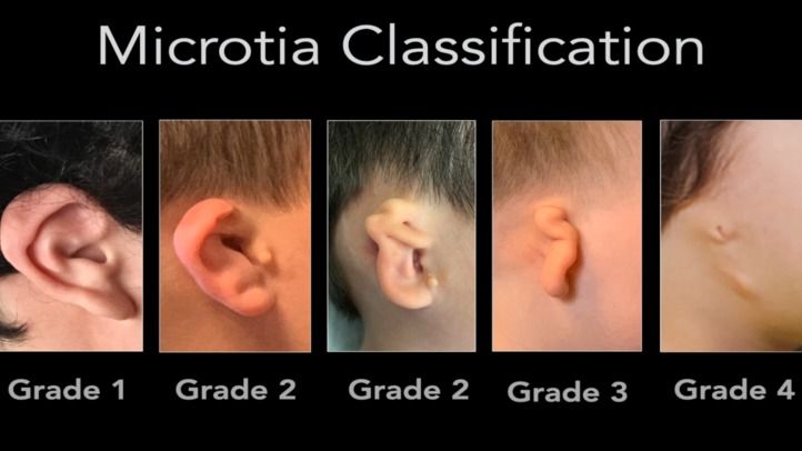 Microtia Reconstruction – Nagata Technique – Dr. Ameen, Pakar Ear, Nose ...