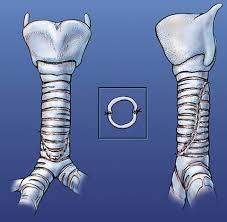 Slide Tracheoplasty – Dr. Ameen, Pakar Ear, Nose and Throat (Adult and ...