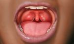 Tonsillitis: Doktor, bila kena buang tonsil (tonsillectomy/ operasi ...