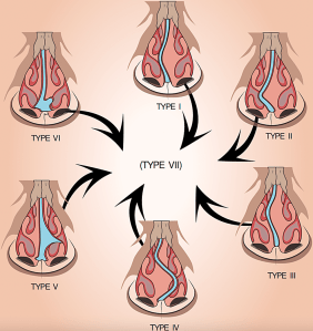 Deviated Nasal Septum: Understanding Causes, Symptoms, Signs, and ...