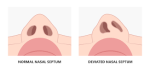 Deviated Nasal Septum: Understanding Causes, Symptoms, Signs, and ...